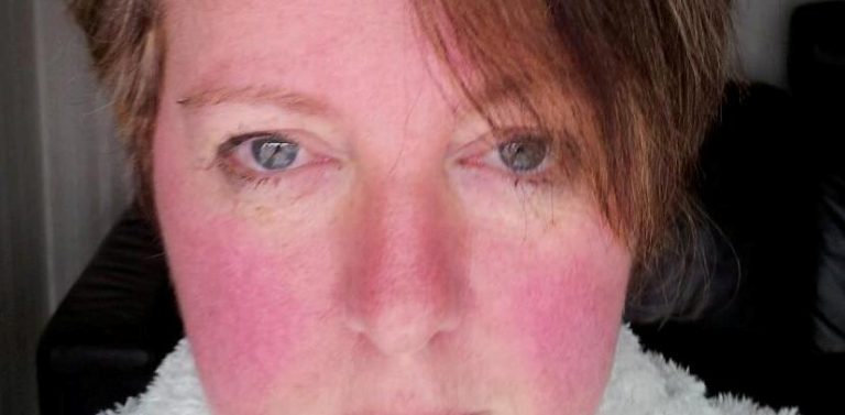 Vasculitis Images - Vasculitis UK